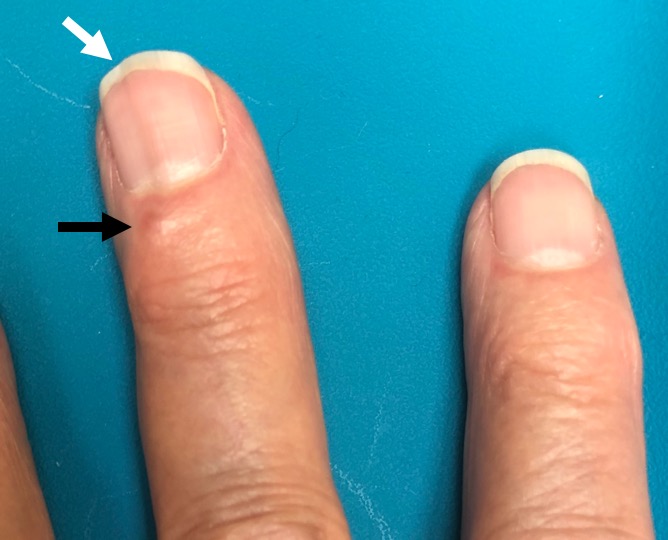 Digital Mucous Cyst Consultant360