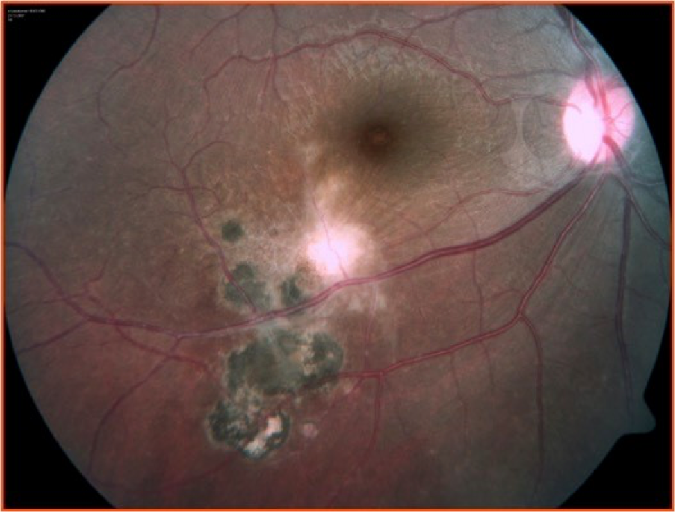 Ocular Toxoplasmosis Consultant360 Ocular Toxoplasmosis Consultant360