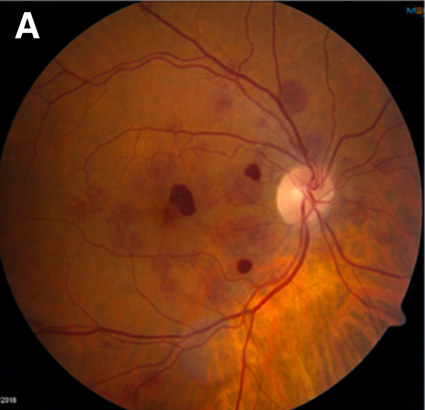 Terson Syndrome: A Case of Intraocular Hemorrhage Secondary to ...