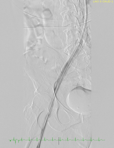 Iliofemoral DVT Progressing to Phlegmasia Cerulea Dolens in a Woman ...