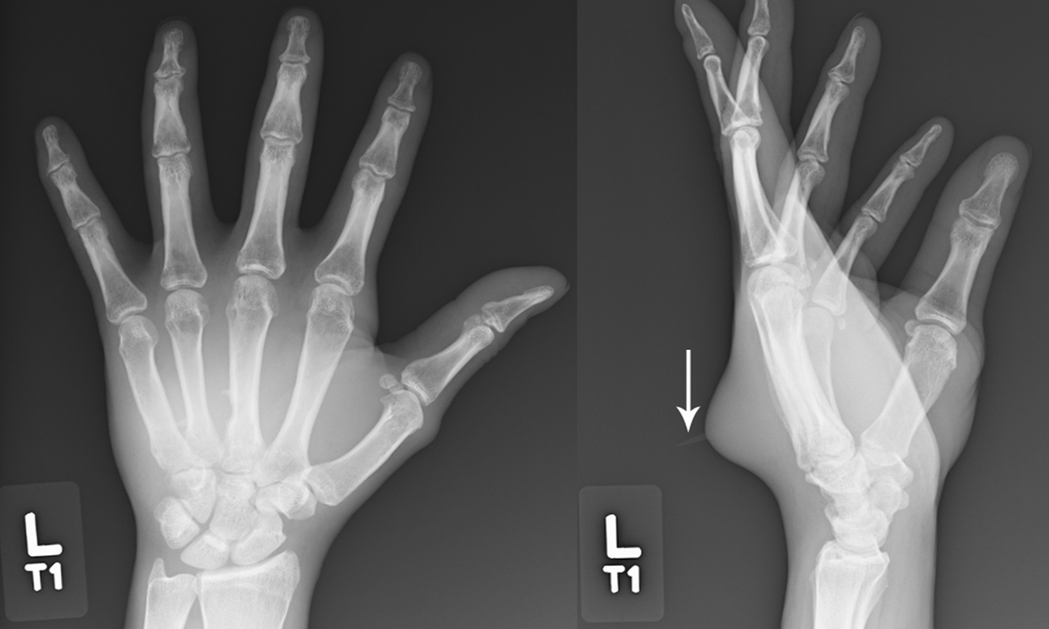 Retained Foreign Body in the Hand | Consultant360