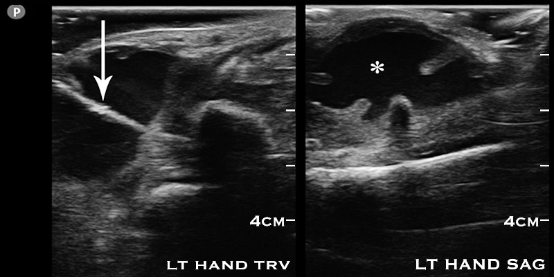 Retained Foreign Body in the Hand | Consultant360