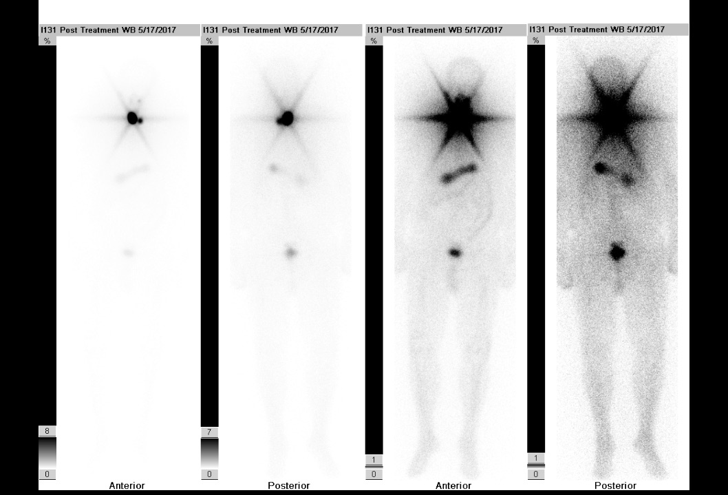 Shear-Wave Elastography in the Evaluation of Thyroid Nodules and ...