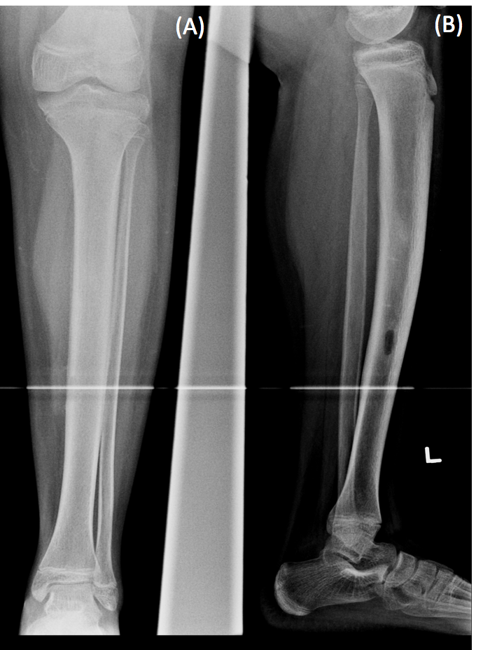 Idiopathic Intramedullary Osteosclerosis | Consultant360