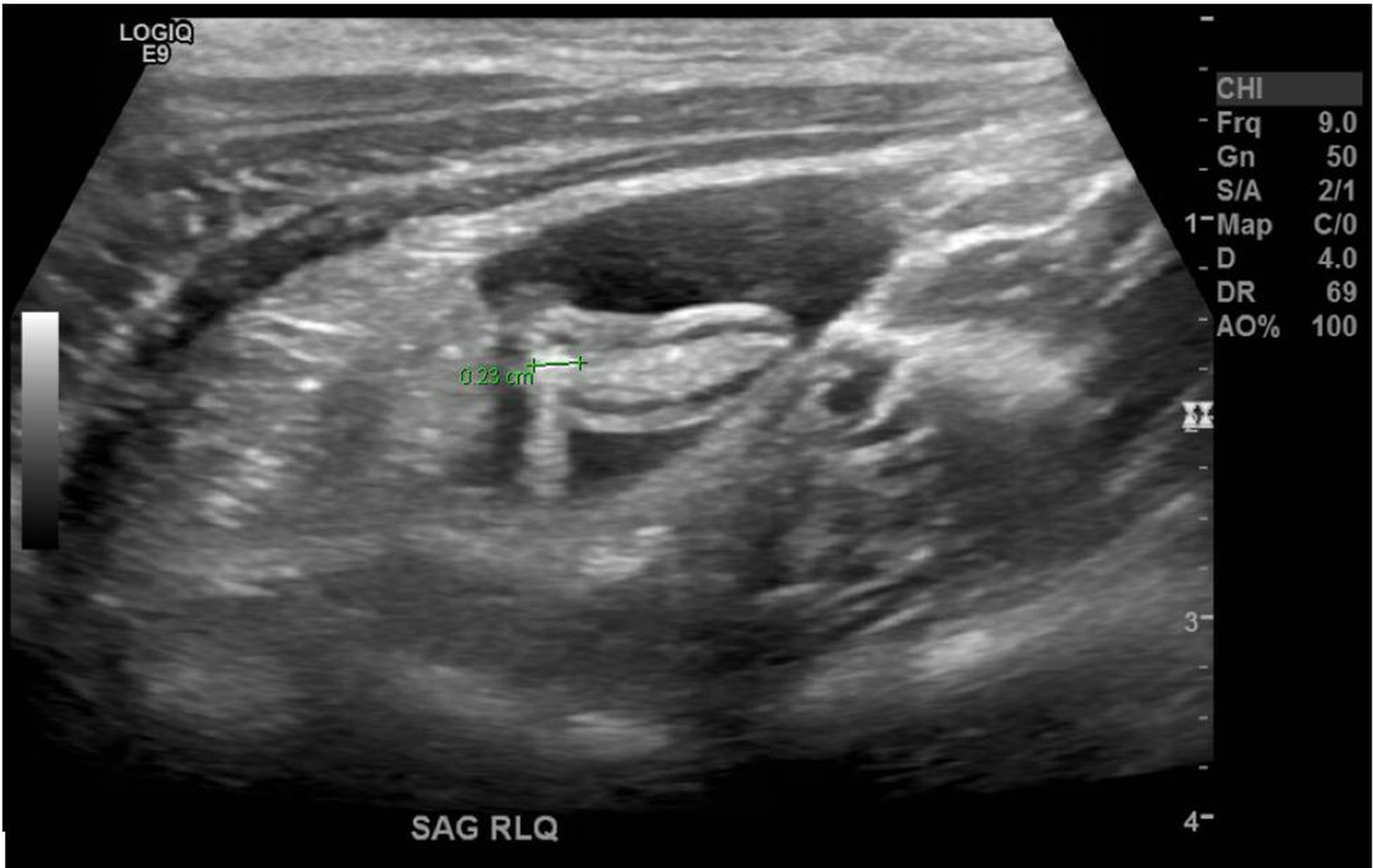 Foreign Body Appendicitis | Consultant360