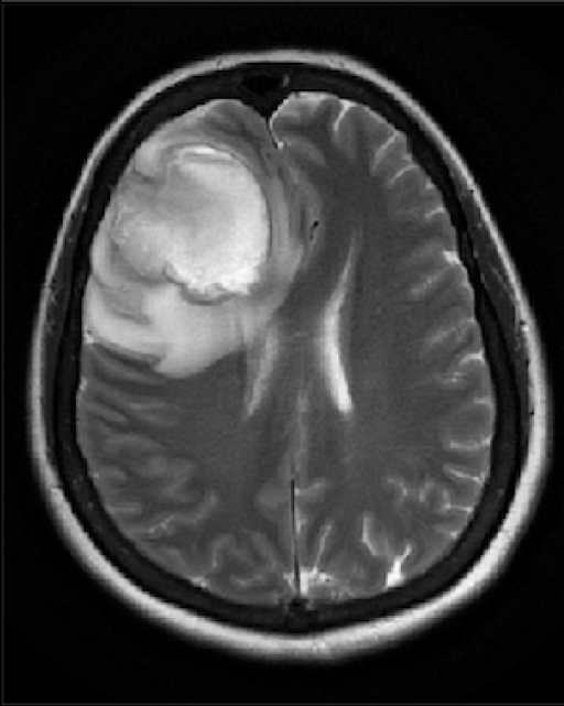 Brain Abscess Due to Streptococcus intermedius Infection | Consultant360