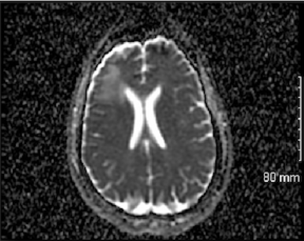 Brain Abscess Due to Streptococcus intermedius Infection | Consultant360