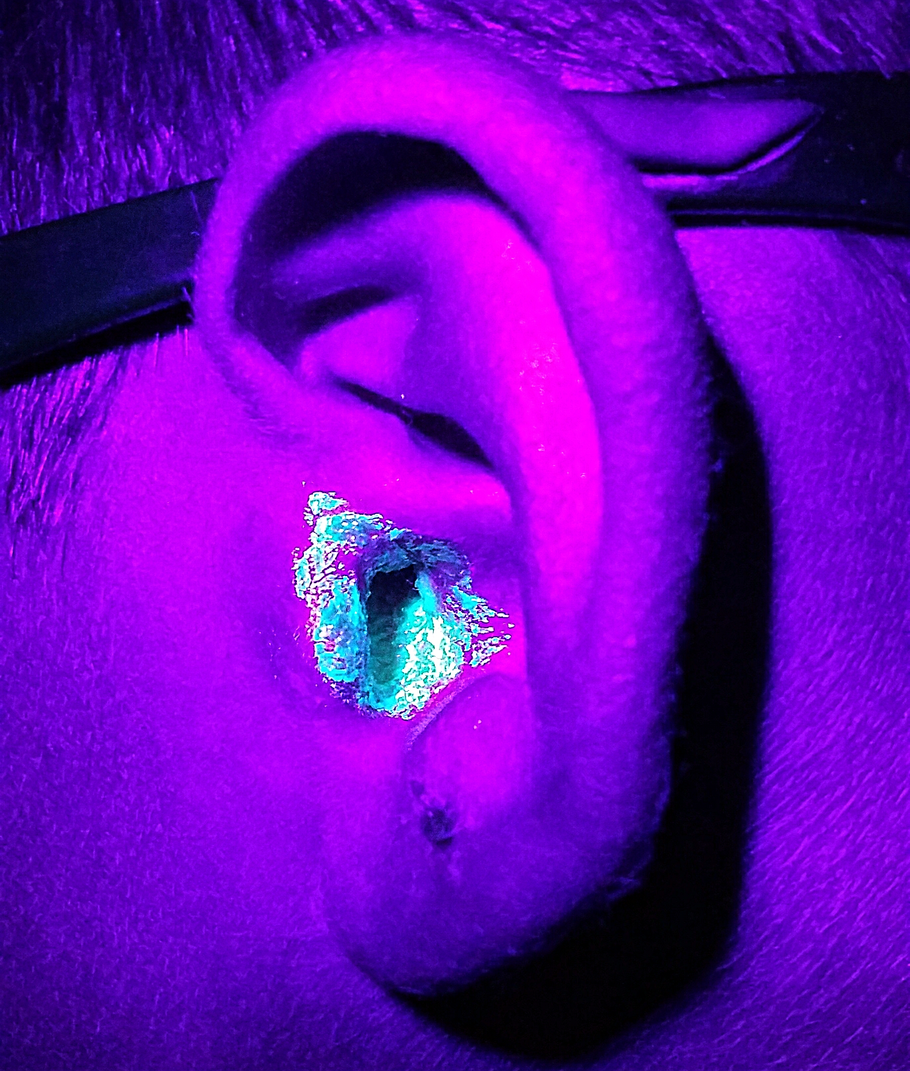 A Boy With Sudden-Onset Left Otalgia and Otorrhea | Consultant360