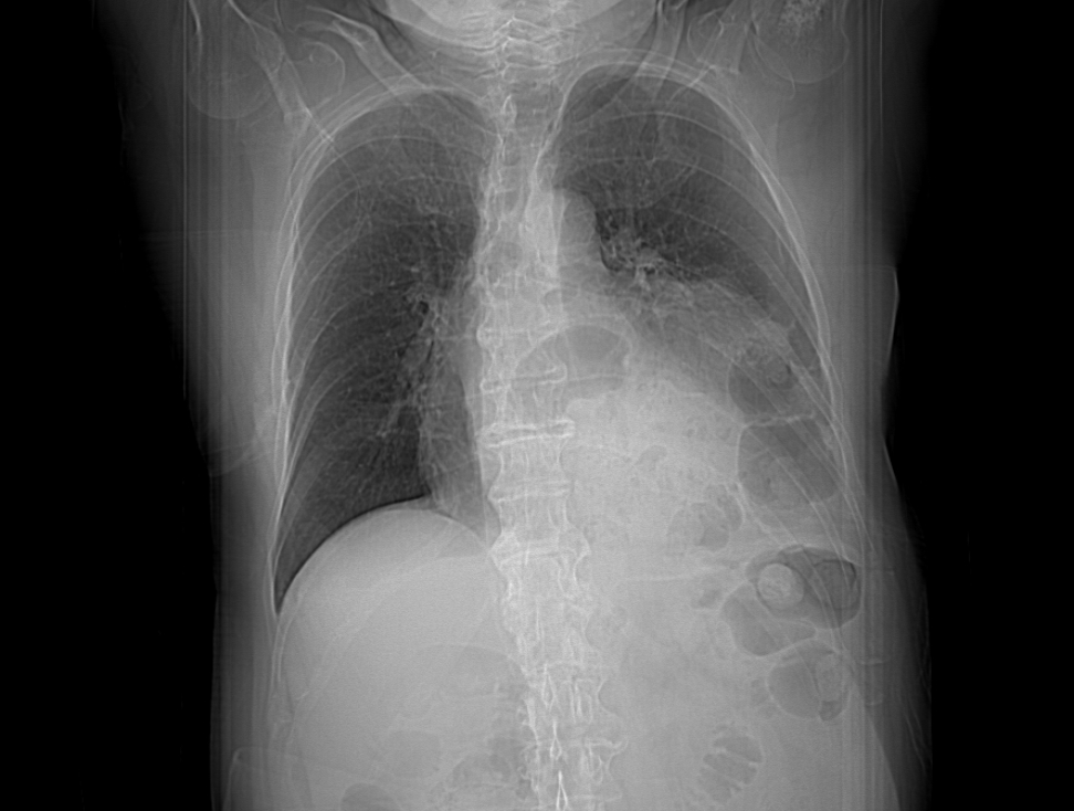 Incidental Ill-Defined Nodular Lung Opacities Discovered During CT ...