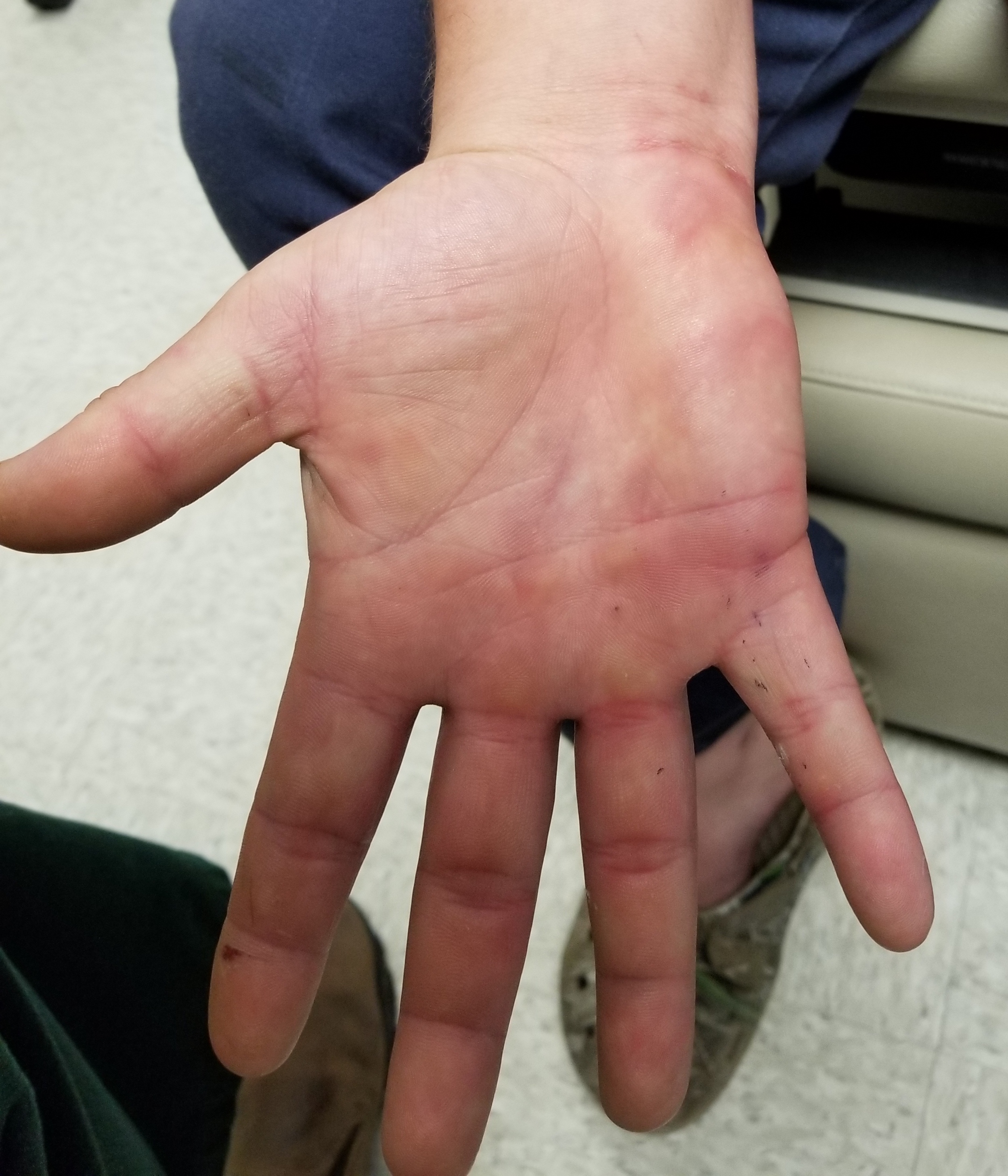 Erythema Multiforme | Consultant360