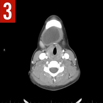Ranula in a 13-Year-Old Girl | Consultant360