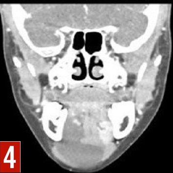 Ranula in a 13-Year-Old Girl | Consultant360