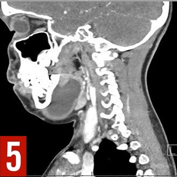 Ranula in a 13-Year-Old Girl | Consultant360