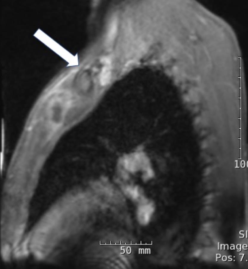 Staphylococcal Toxic Shock Syndrome From Methicillin-Susceptible ...
