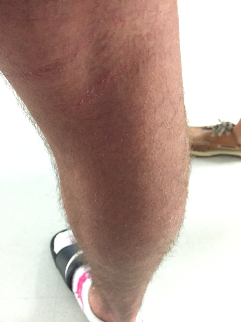 Staphylococcal Toxic Shock Syndrome From Methicillin-Susceptible ...