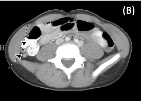 Atypical Appendicitis | Consultant360