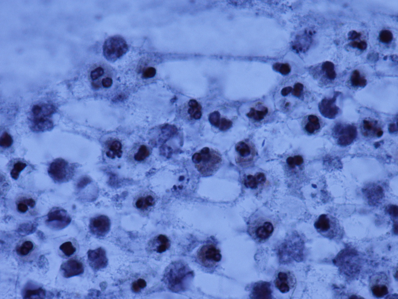 Hepatic and Pulmonary Abscesses From Fusobacterium nucleatum Infection ...