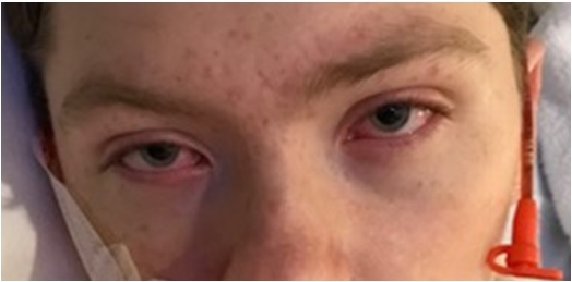 Mycoplasma pneumoniae–Induced Rash and Mucositis: 2 Pediatric Cases ...