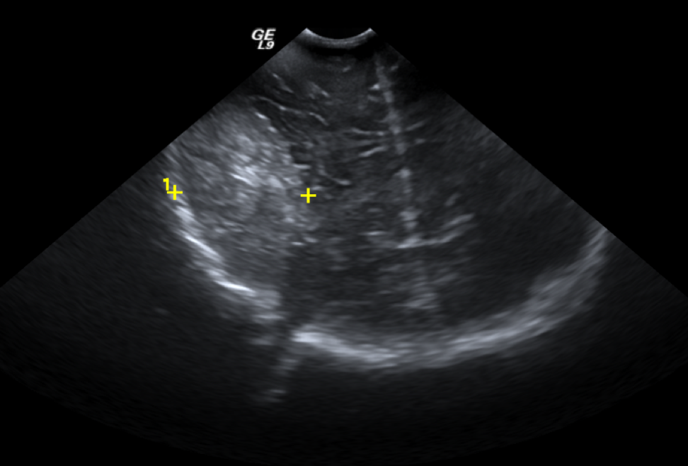 Severe Anemia Associated With Intracranial Hemorrhage in an Infant ...
