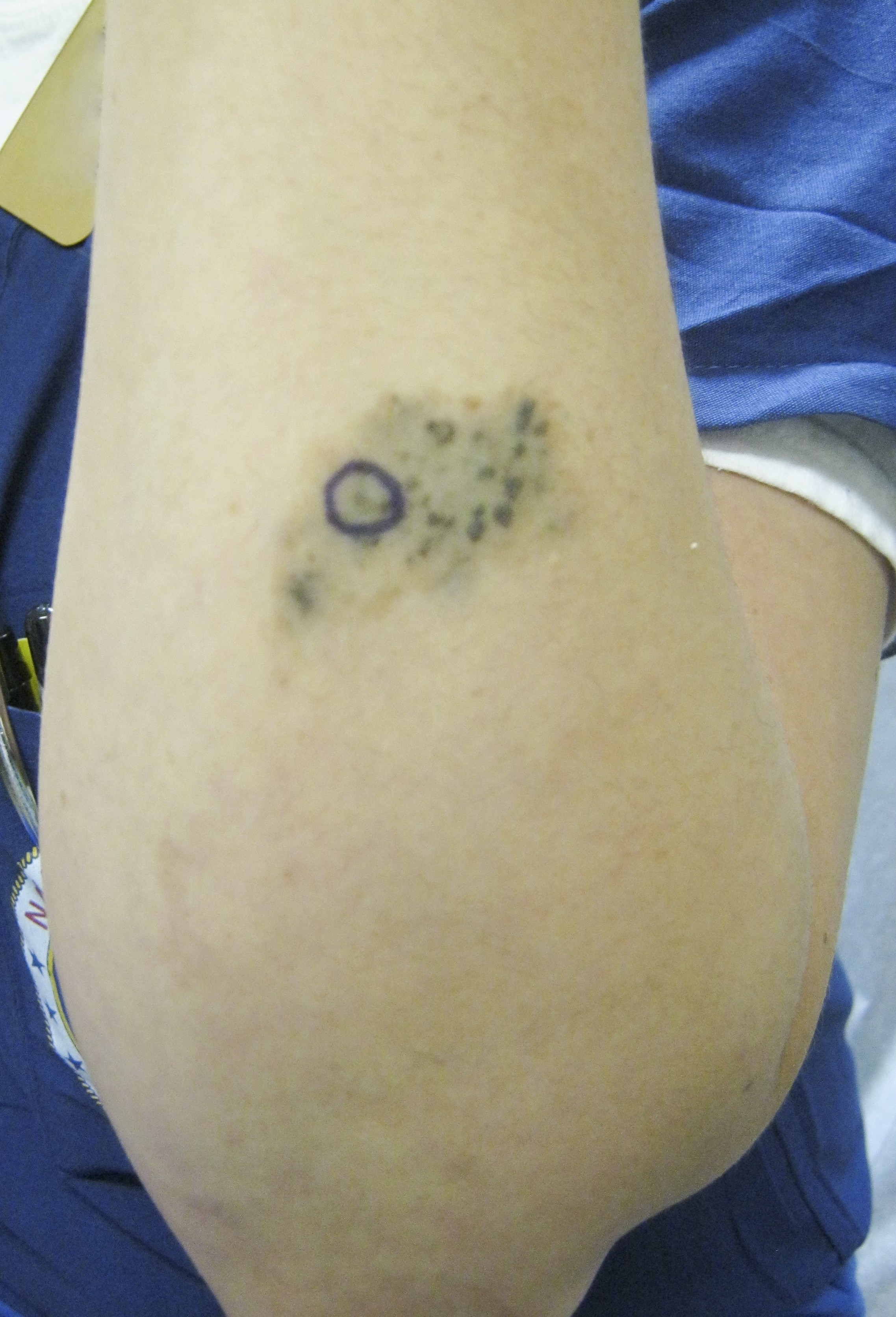 Agminated Blue Nevus Arising in a Nevus Spilus | Consultant360