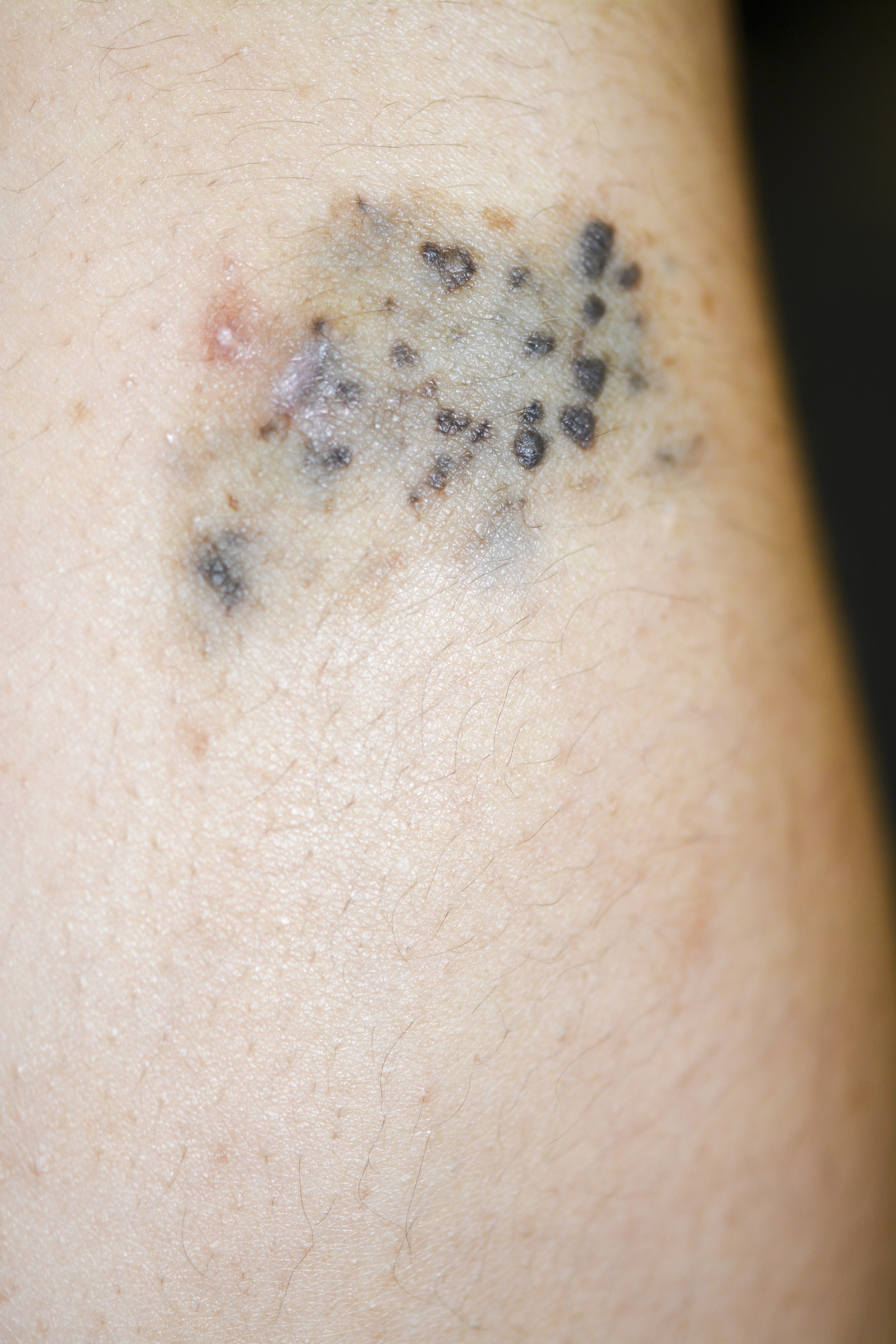 Agminated Blue Nevus Arising in a Nevus Spilus | Consultant360