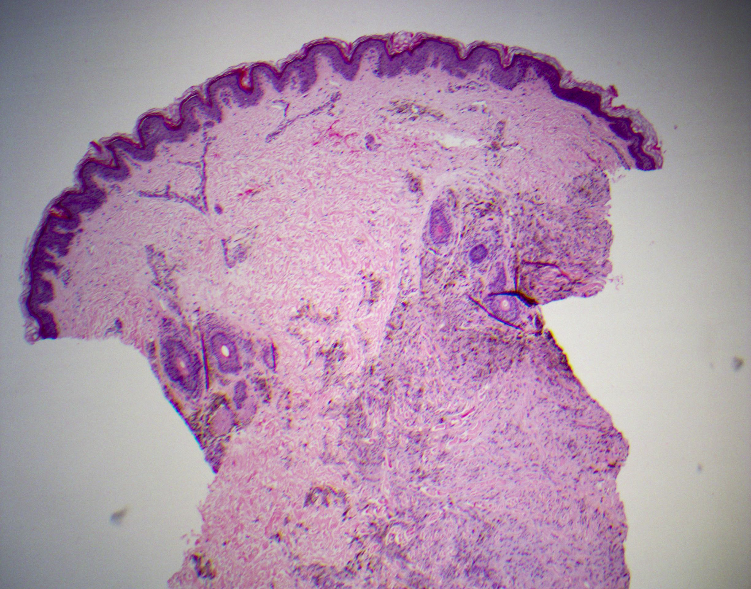 Agminated Blue Nevus Arising in a Nevus Spilus | Consultant360