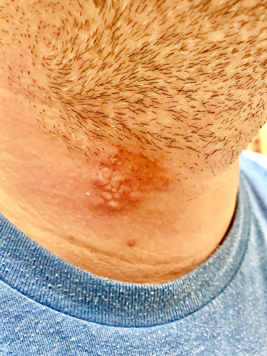 What’s Causing This Man’s Folliculitis Barbae? | Consultant360