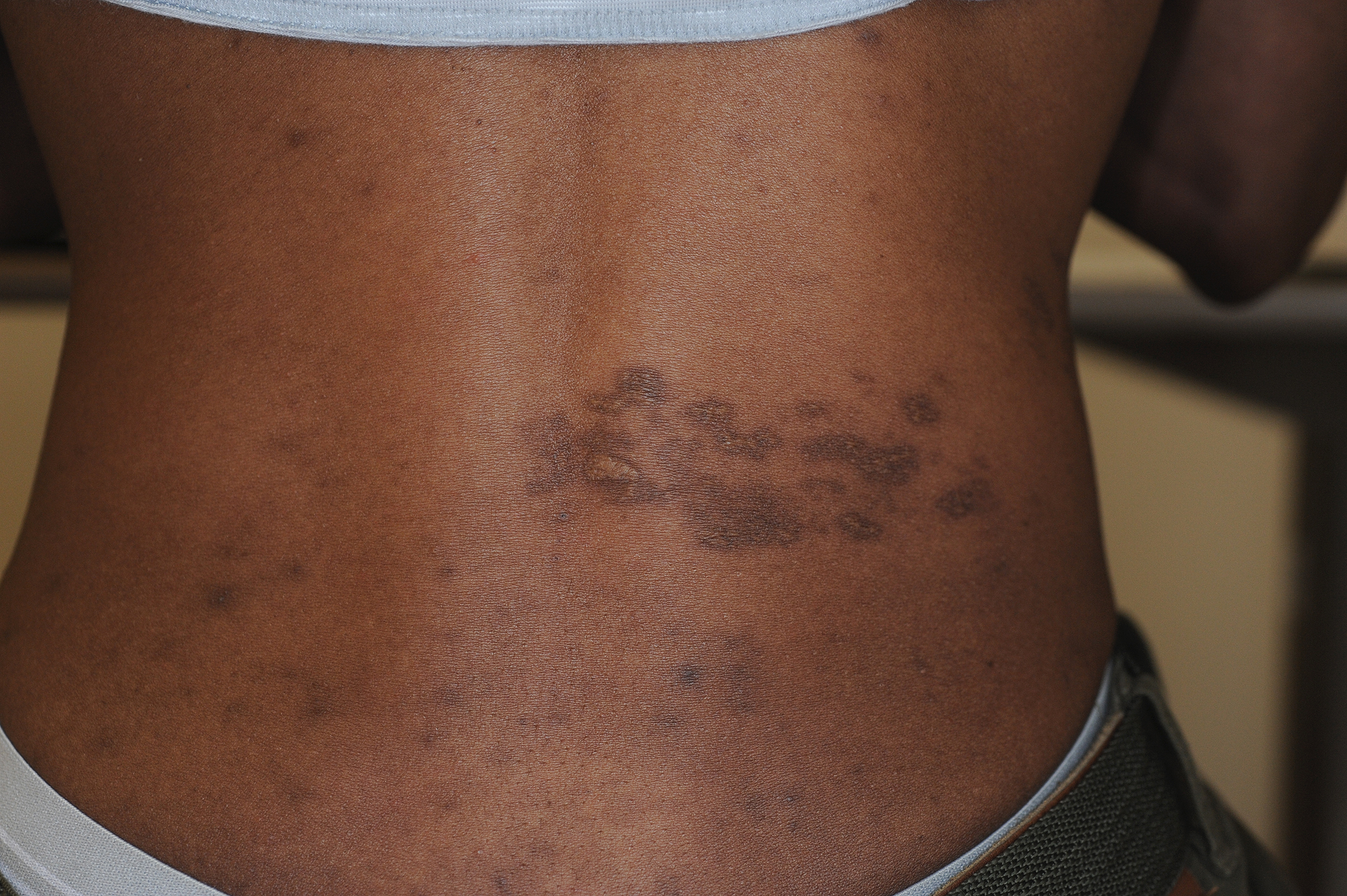 Syphilitic Meningitis | Consultant360