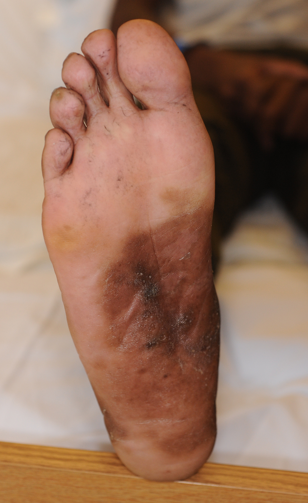 Syphilitic Meningitis | Consultant360