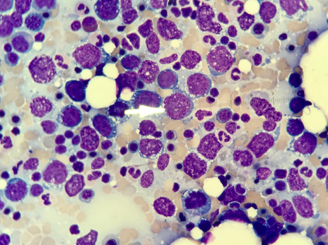 Diffuse Large B-Cell Non-Hodgkin Lymphoma Presenting as Acute ...