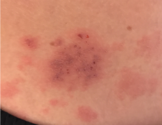 Varicella-Zoster Virus Infection | Consultant360