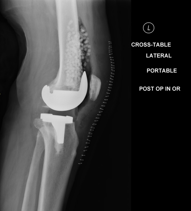 Streptococcus canis Infection of a Prosthetic Knee Joint | Consultant360