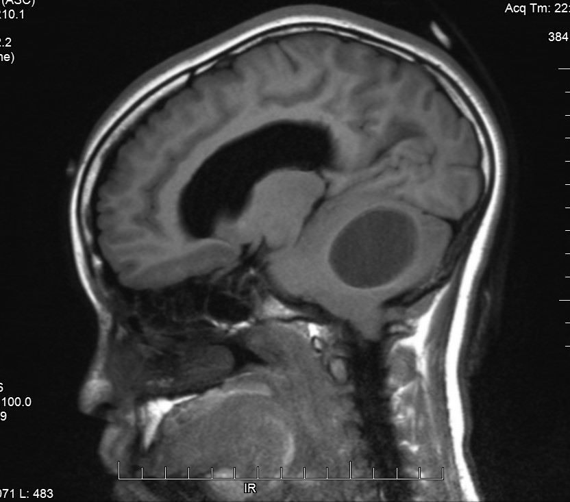 Pilocytic Astrocytoma | Consultant360