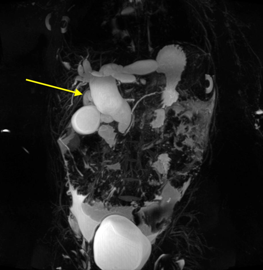 Choledochal Cyst | Consultant360