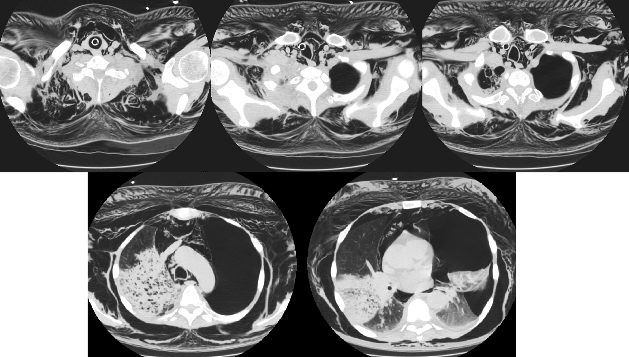 Tracheal Perforation, a Life-Threatening Complication of Endotracheal ...