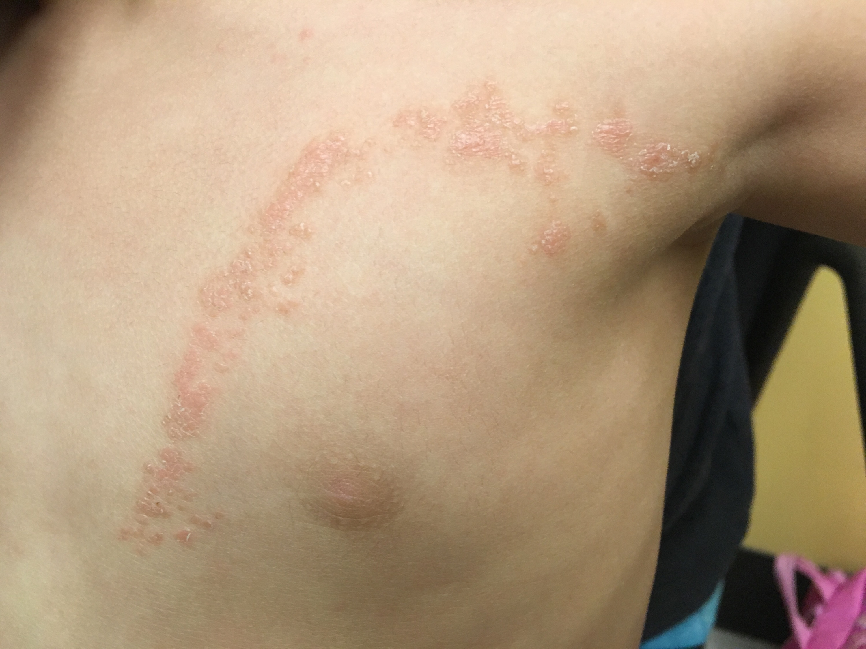 Lichen Striatus | Consultant360