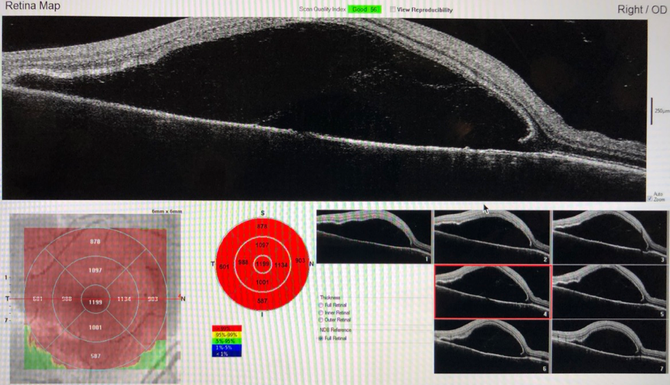 Vogt-Koyanagi-Harada Disease | Consultant360