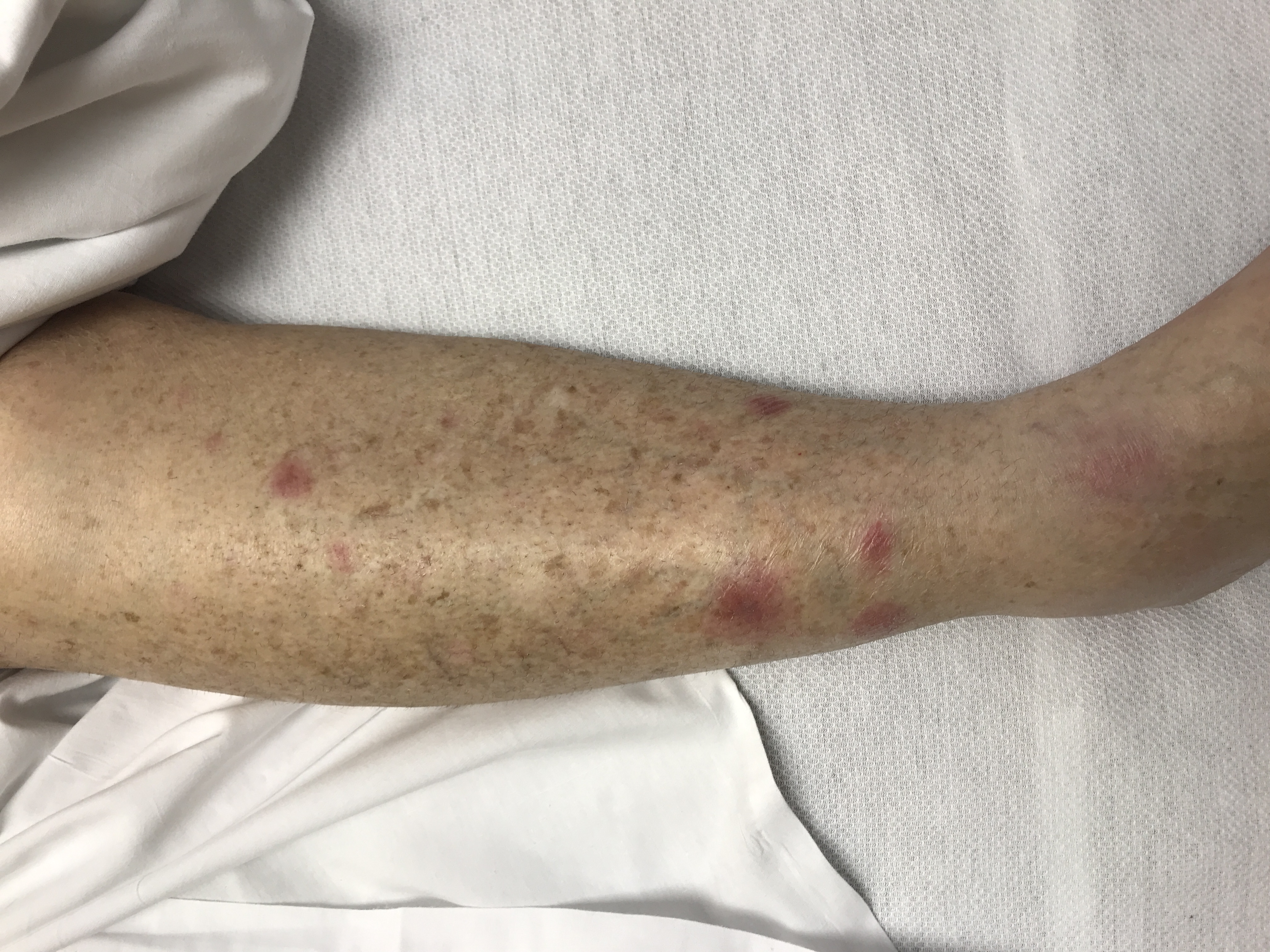 Pyoderma Gangrenosum With Systemic Symptoms Initially Misdiagnosed as ...