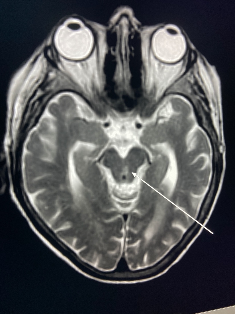 Isolated Unilateral Oculomotor Nerve Paresis: An Uncommon Presentation ...
