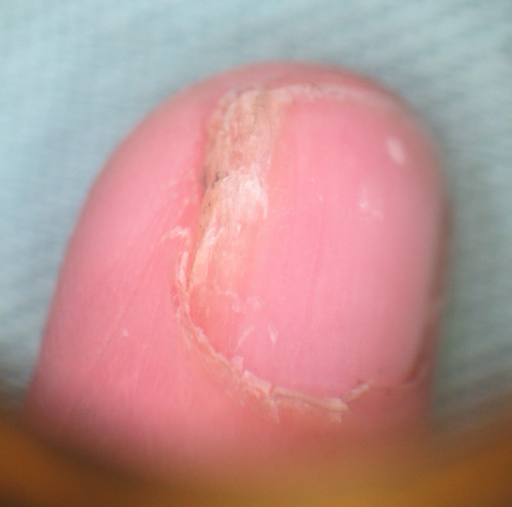 An Atlas of Nail Disorders, Part 9 | Consultant360