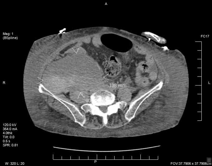 Spontaneous Psoas Hematoma Secondary to Anticoagulation | Consultant360