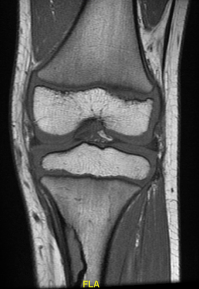 Nonossifying Fibroma | Consultant360