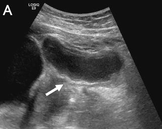 Recurrent Tubo-Ovarian Abscess in a Nonsexually Active Adolescent ...