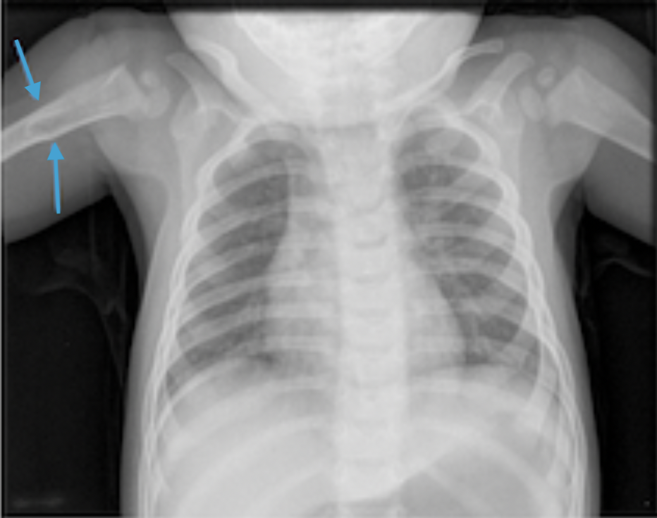 Hereditary Multiple Osteochondromas | Consultant360