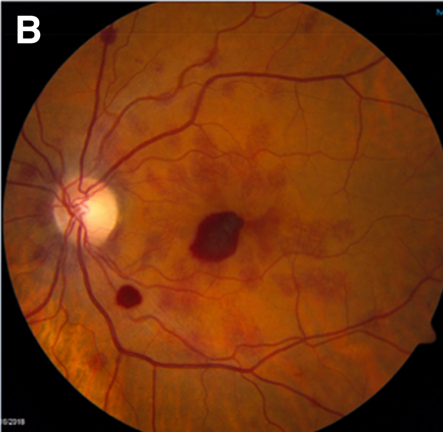 Terson Syndrome: A Case of Intraocular Hemorrhage Secondary to ...