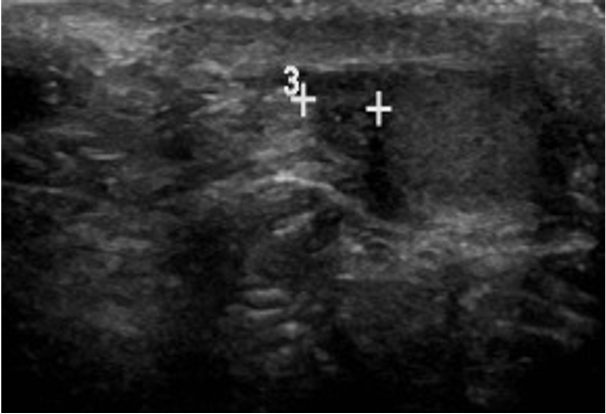 Pediatric Scrotal Dog Bite | Consultant360
