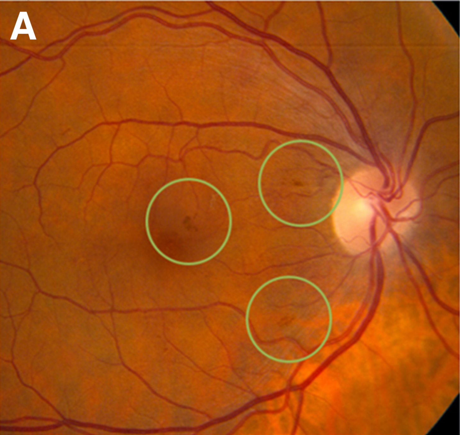 Terson Syndrome: A Case of Intraocular Hemorrhage Secondary to ...