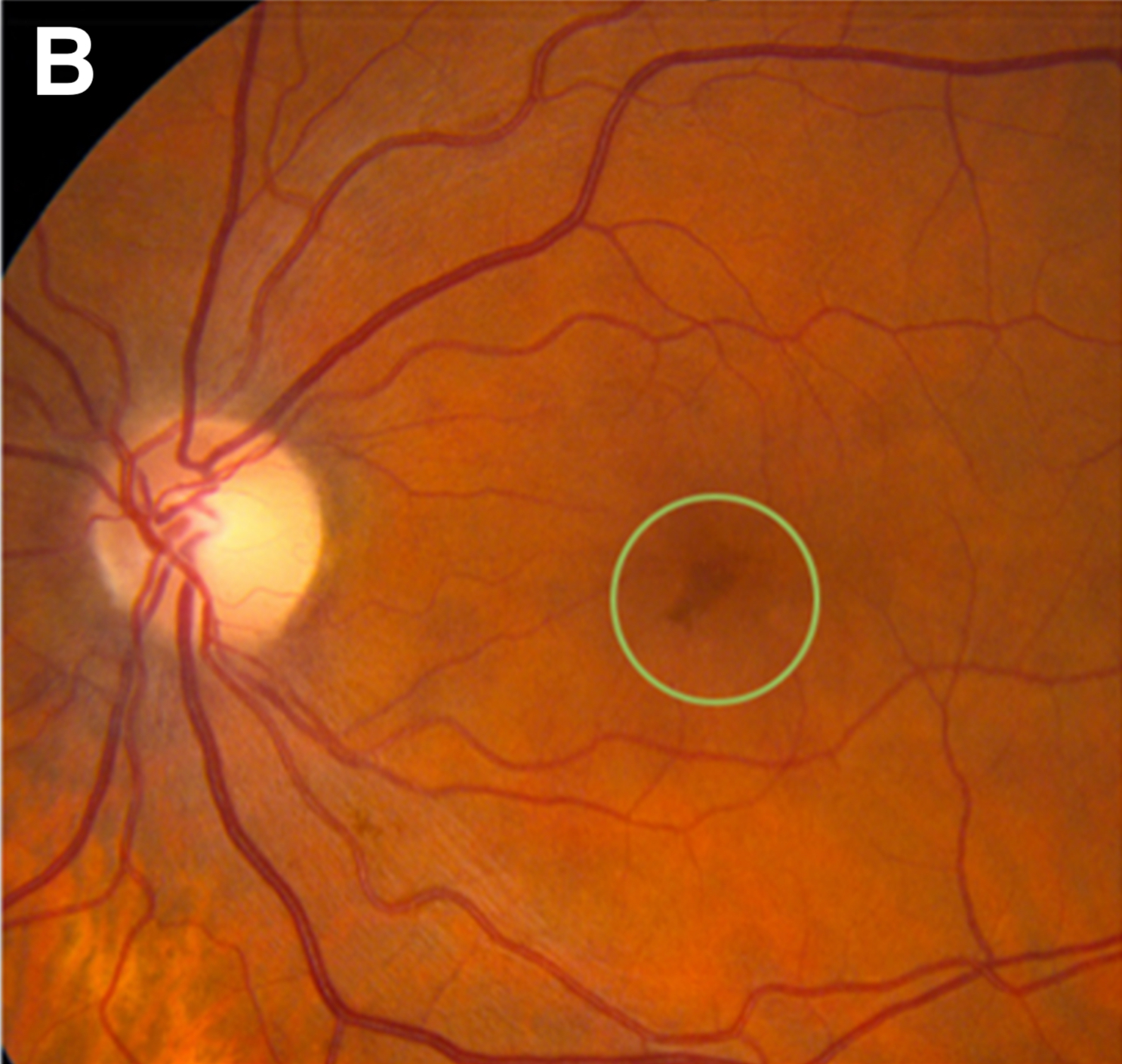 Terson Syndrome: A Case of Intraocular Hemorrhage Secondary to ...