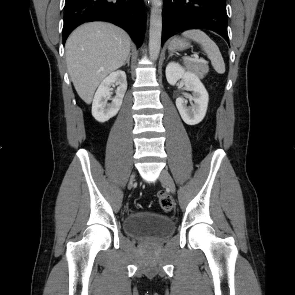 Subclinical Pyelonephritis Presenting as Relapsing Fever: A Prodrome in ...