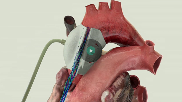 The C-Pulse Heart Assist Device: A Less Invasive Heart Failure Treatment